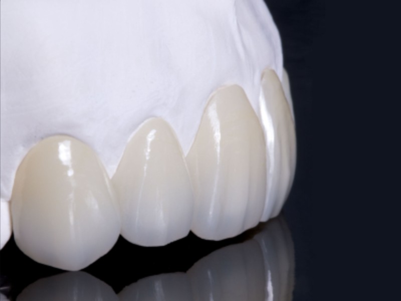 Modified Begg Retainer RDL | Russellville Dental Lab