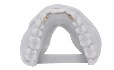 Lingual Retainer RDL | Russellville Dental Lab