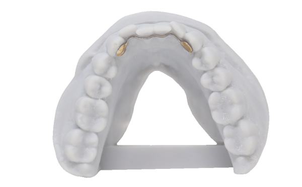 Lingual Retainer RDL | Russellville Dental Lab