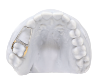 Space Maintainer RDL | Russellville Dental Lab