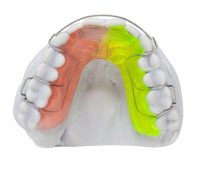 Spring Hawley Retainer RDL | Russellville Dental Lab