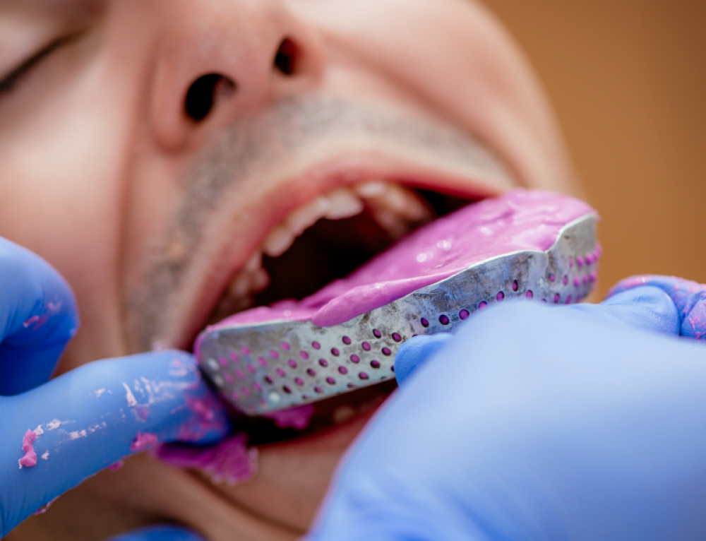 New Crown Under Existing Partial Denture Workflow RDL | Russellville ...