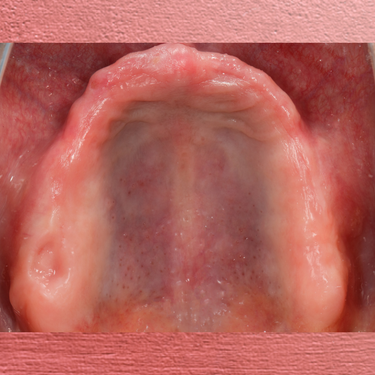 Fully Digital Solution for Full Denture in an Edentulous Patient ... Fully Digital Solution for Full Denture in an Edentulous Patient ...