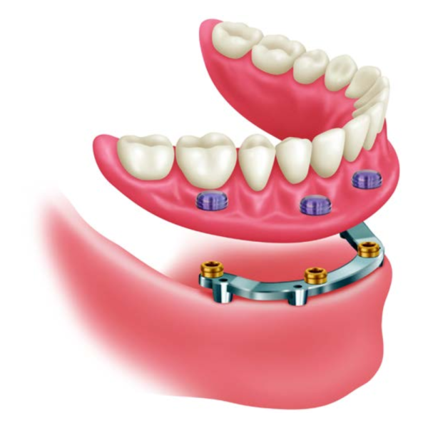 Zest Locator Abutments and Overdentures at RDL | Russellville Dental Lab