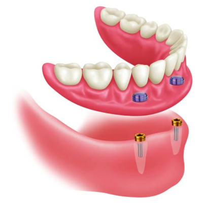 Zest Locator Abutments and Overdentures at RDL | Russellville Dental Lab