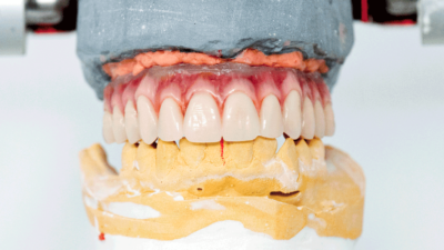 Restorative Evaluation for Full Arch Immmediate Load (All-On-X ...